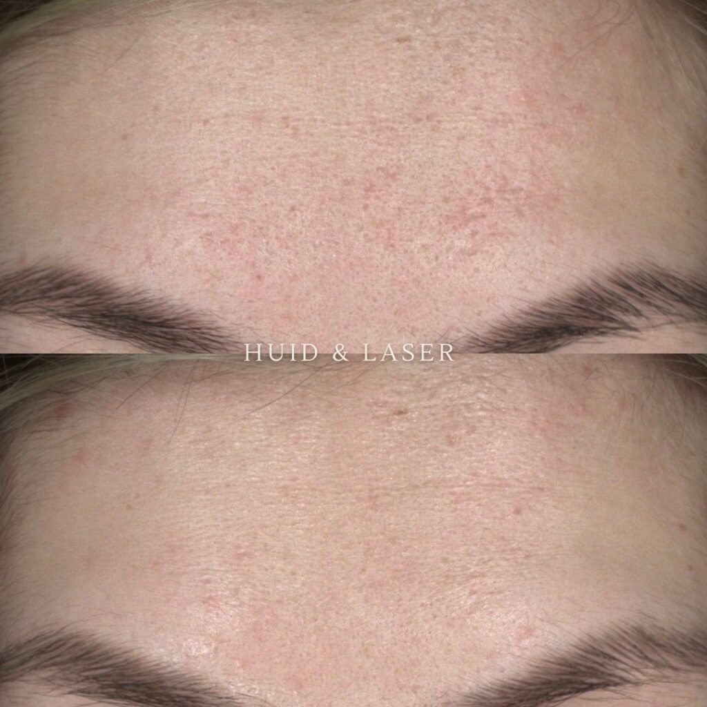 Huid & Laser Denekamp | Microneedling | Littekens